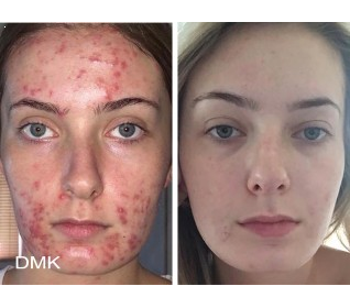 DMK Result - Enzyme Therapy for Revising Skin in Australia and New Zealand