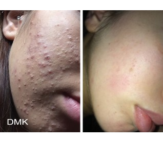 DMK Result - Enzyme Therapy for Revising Skin in Australia and New Zealand