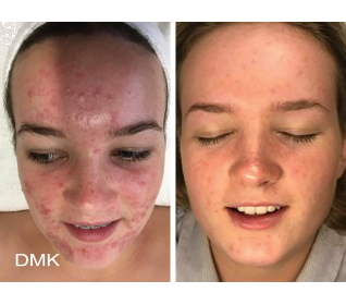 DMK Result - Enzyme Therapy for Revising Skin in Australia and New Zealand