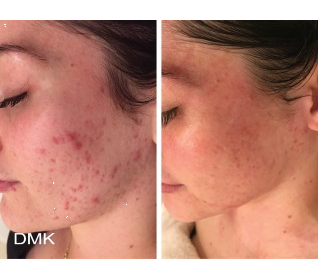 DMK Result - Enzyme Therapy for Revising Skin in Australia and New Zealand