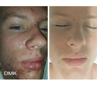DMK Result - Enzyme Therapy for Revising Skin in Australia and New Zealand