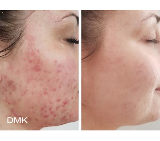 DMK Result - Enzyme Therapy for Revising Skin in Australia and New Zealand