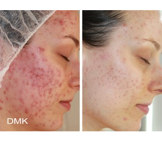 DMK Result - Enzyme Therapy for Revising Skin in Australia and New Zealand