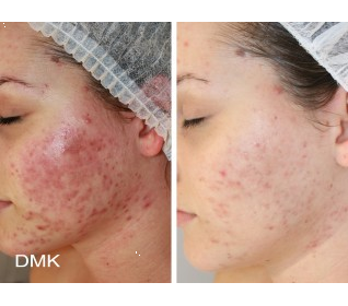DMK Result - Enzyme Therapy for Revising Skin in Australia and New Zealand