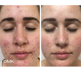 DMK Result - Revising Skin Conditions and Facial Enzyme Therapy