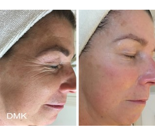 DMK Result - Revising Skin Conditions and Facial Enzyme Therapy