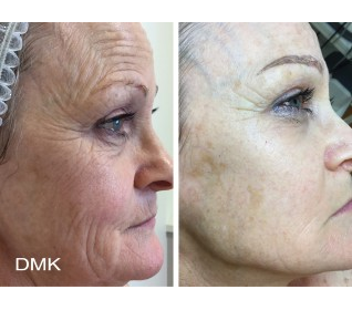 DMK Result - Enzyme Therapy for Revising Skin in Australia and New Zealand