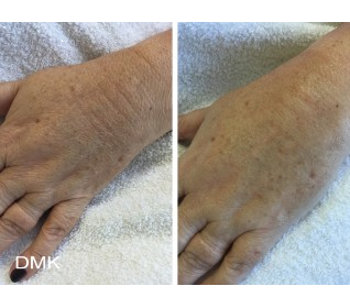 DMK Result - Enzyme Therapy for Revising Skin in Australia and New Zealand