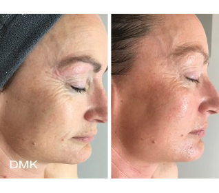 DMK Result - Enzyme Therapy for Revising Skin in Australia and New Zealand