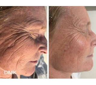 DMK Result - Enzyme Therapy for Revising Skin in Australia and New Zealand