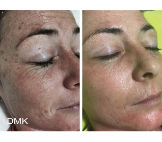 DMK Result - Revising Skin Conditions and Facial Enzyme Therapy
