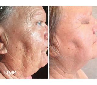 DMK Result - Enzyme Therapy for Revising Skin in Australia and New Zealand