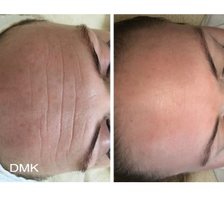 DMK Result - Enzyme Therapy for Revising Skin in Australia and New Zealand