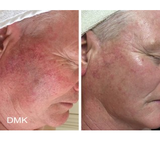 DMK Result - Enzyme Therapy for Revising Skin in Australia and New Zealand