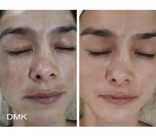 DMK Result - Enzyme Therapy for Revising Skin in Australia and New Zealand