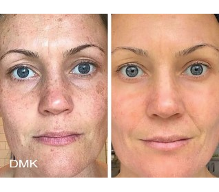 DMK Result - Enzyme Therapy for Revising Skin in Australia and New Zealand