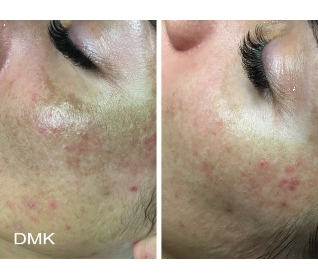 DMK Result - Enzyme Therapy for Revising Skin in Australia and New Zealand