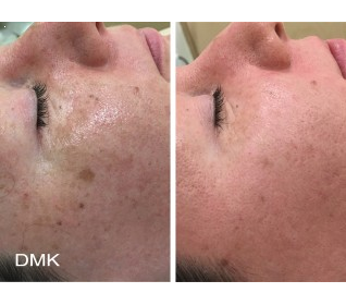 DMK Result - Enzyme Therapy for Revising Skin in Australia and New Zealand