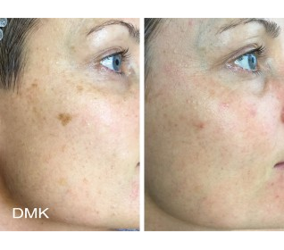 DMK Result - Enzyme Therapy for Revising Skin in Australia and New Zealand