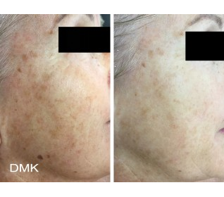 DMK Result - Enzyme Therapy for Revising Skin in Australia and New Zealand