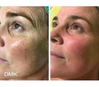 DMK Result - Enzyme Therapy for Revising Skin in Australia and New Zealand
