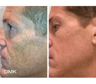 DMK Result - Revising Skin Conditions and Facial Enzyme Therapy