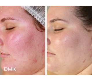 DMK Result - Enzyme Therapy for Revising Skin in Australia and New Zealand
