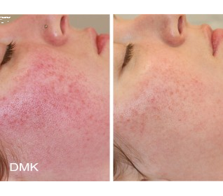 DMK Result - Enzyme Therapy for Revising Skin in Australia and New Zealand
