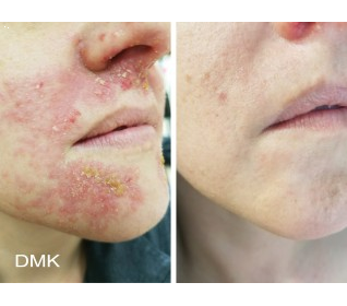 DMK Result - Enzyme Therapy for Revising Skin in Australia and New Zealand