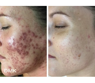 DMK Result - Enzyme Therapy for Revising Skin in Australia and New Zealand