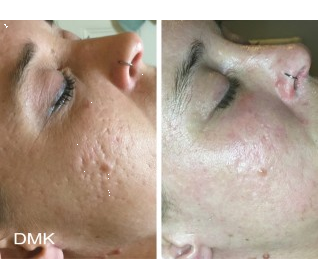 DMK Result - Enzyme Therapy for Revising Skin in Australia and New Zealand