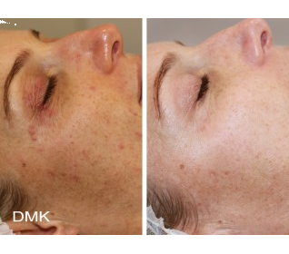 DMK Result - Enzyme Therapy for Revising Skin in Australia and New Zealand