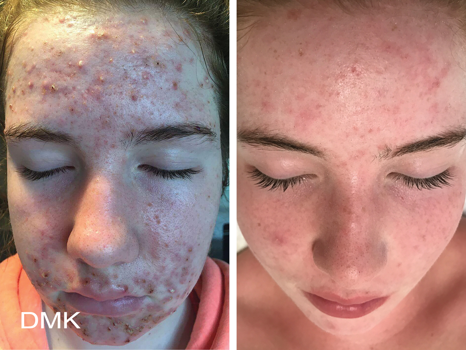 Acne - DMK Results - DMKCustomer