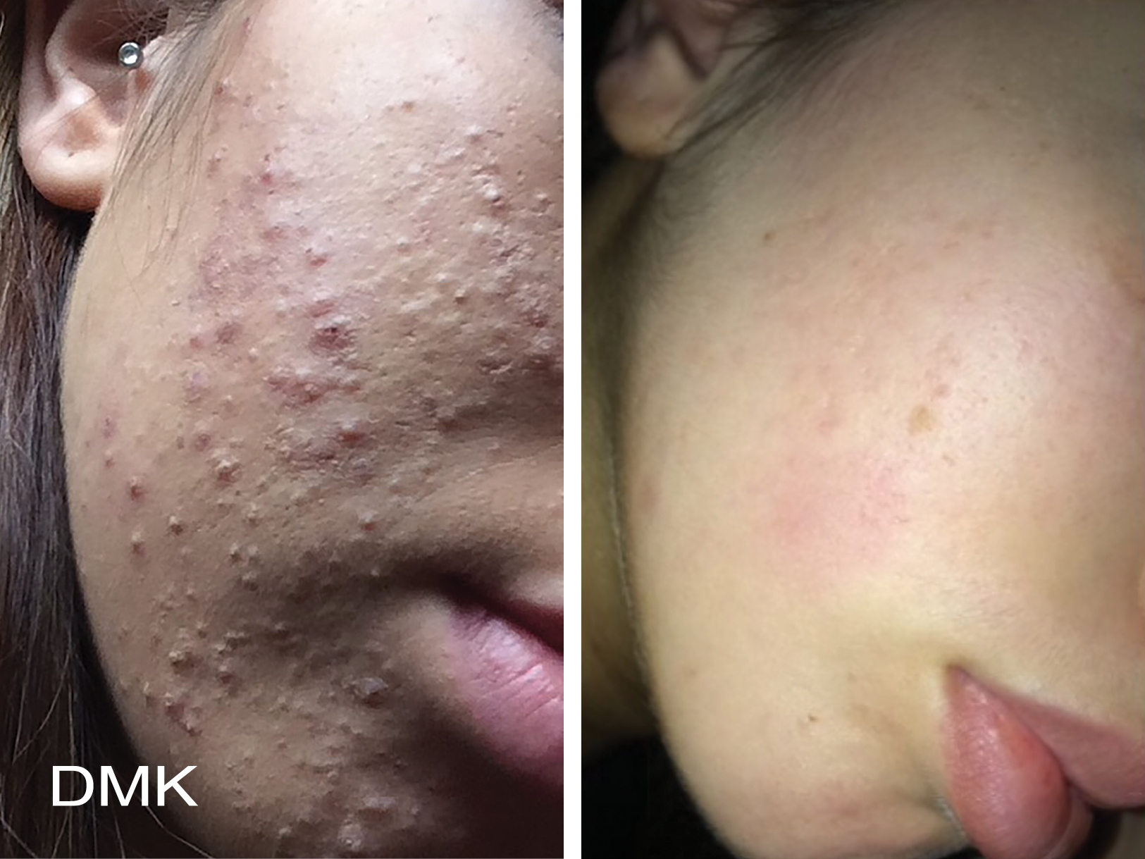 Acne - DMK Results - DMKCustomer