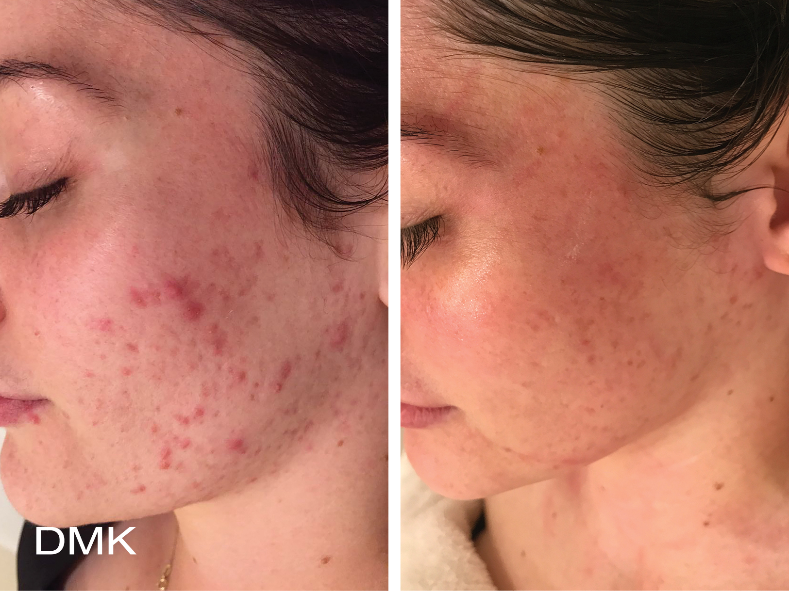 Acne - DMK Results - DMKCustomer