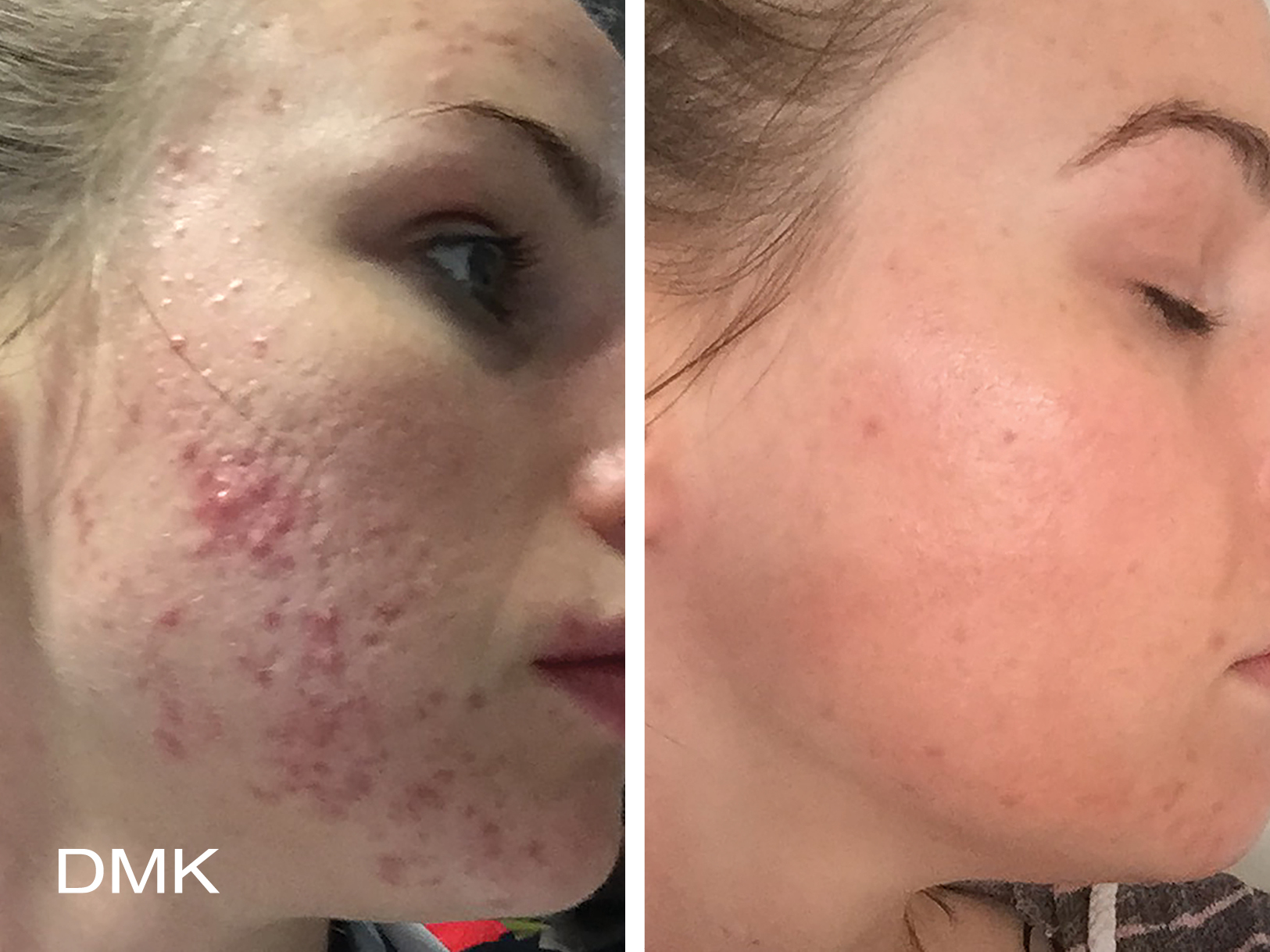 Acne - DMK Results - DMKCustomer