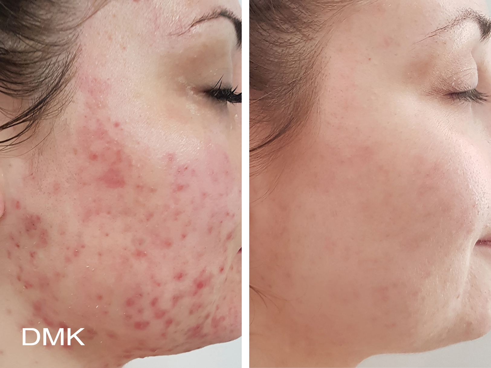 Acne - DMK Results - DMKCustomer