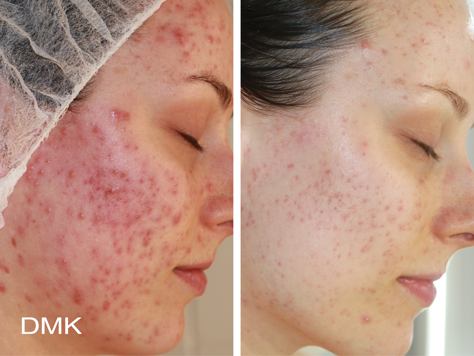 Acne - DMK Results - DMKCustomer