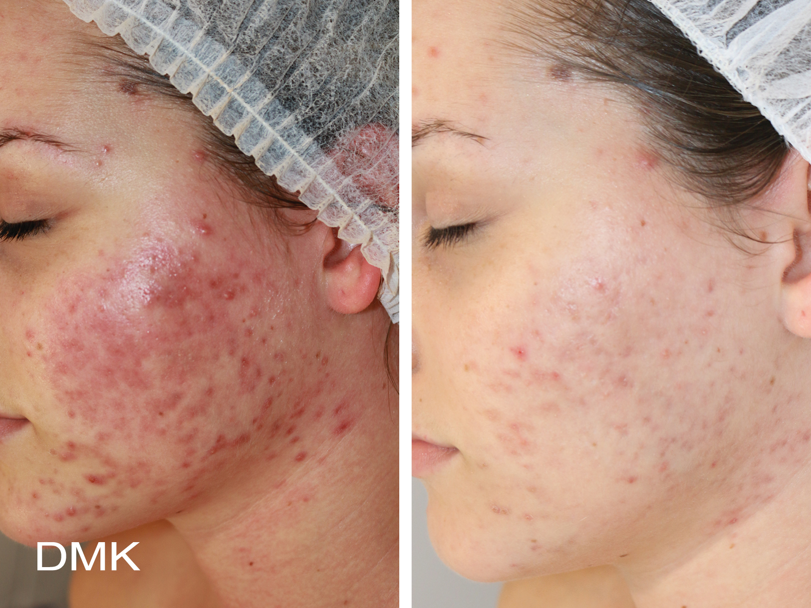 Acne - DMK Results - DMKCustomer