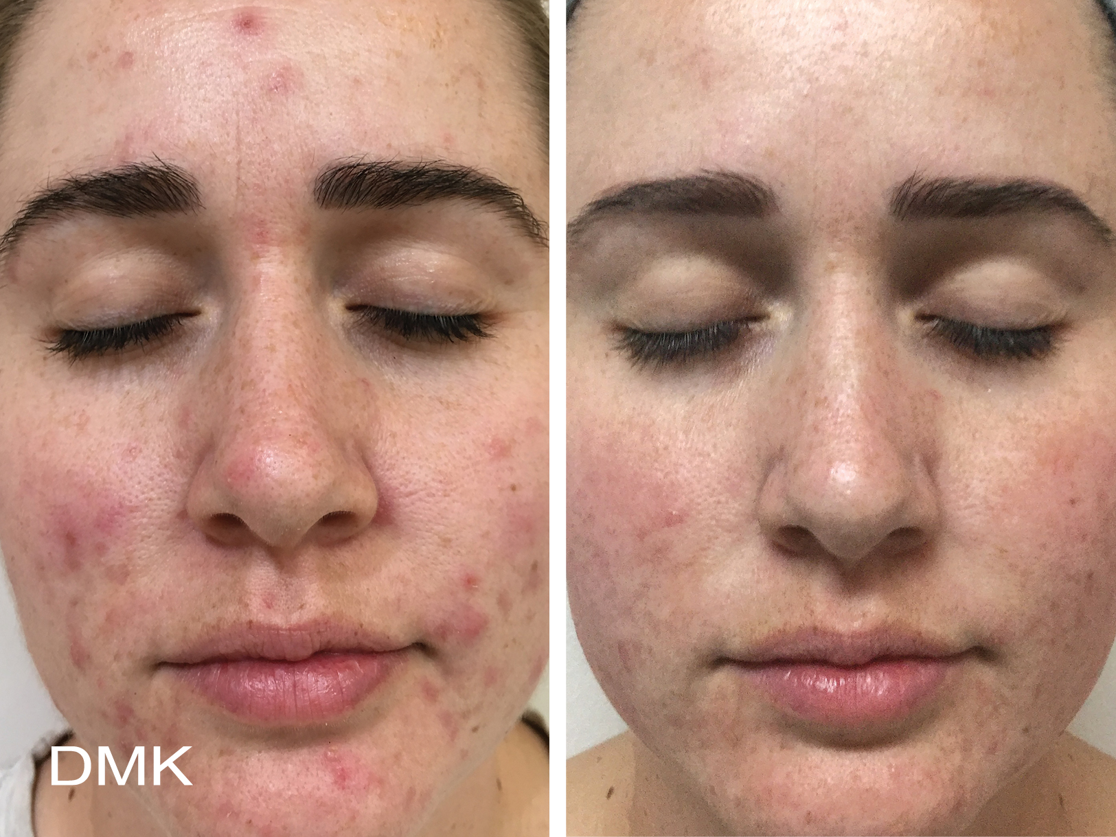 Acne - DMK Results - DMKCustomer