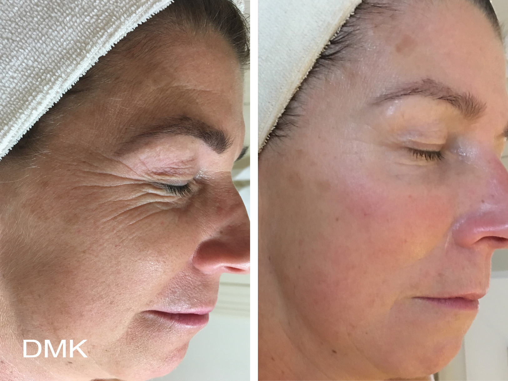 Ageing - DMK Results - DMKCustomer