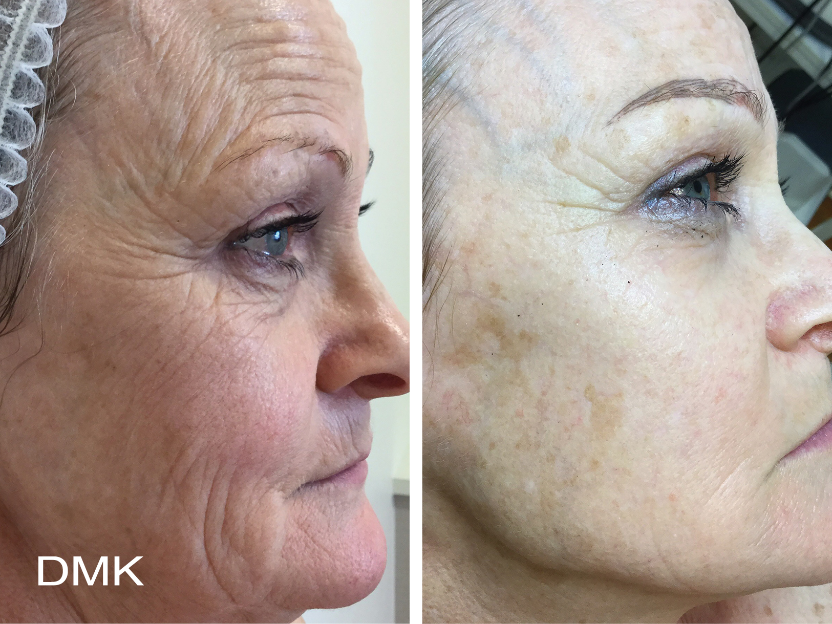 Ageing - DMK Results - DMKCustomer