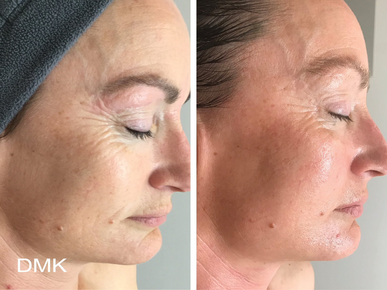 Ageing - DMK Results - DMKCustomer