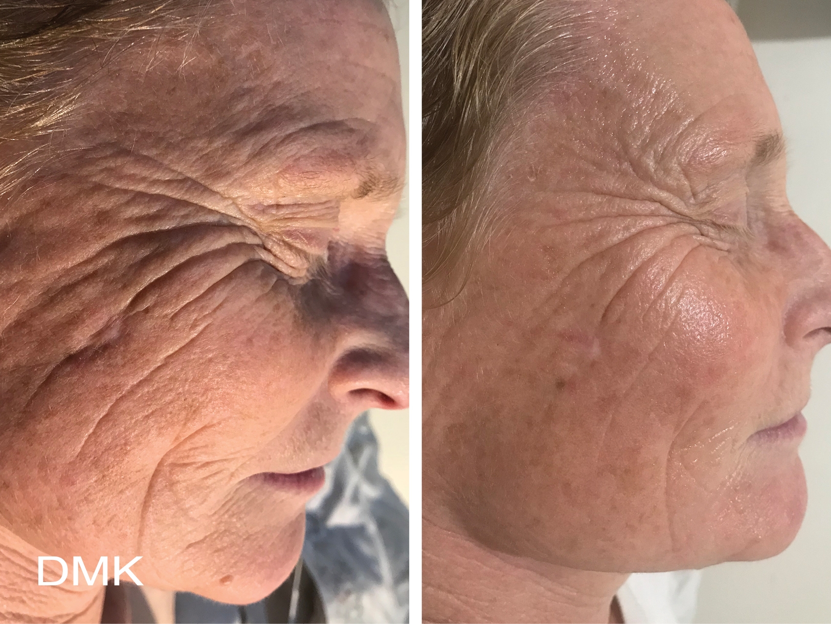 Ageing - DMK Results - DMKCustomer