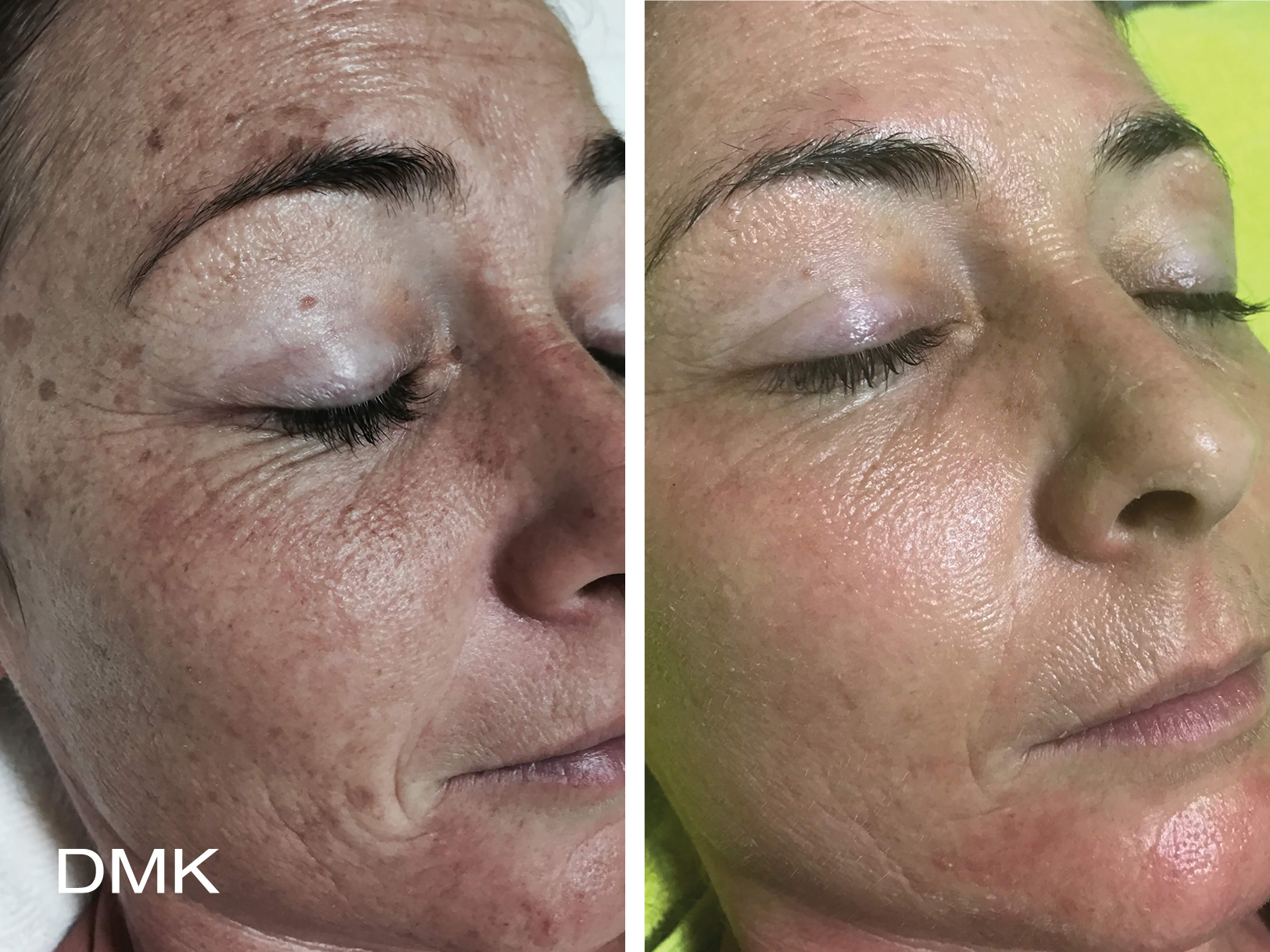 Ageing - DMK Results - DMKCustomer