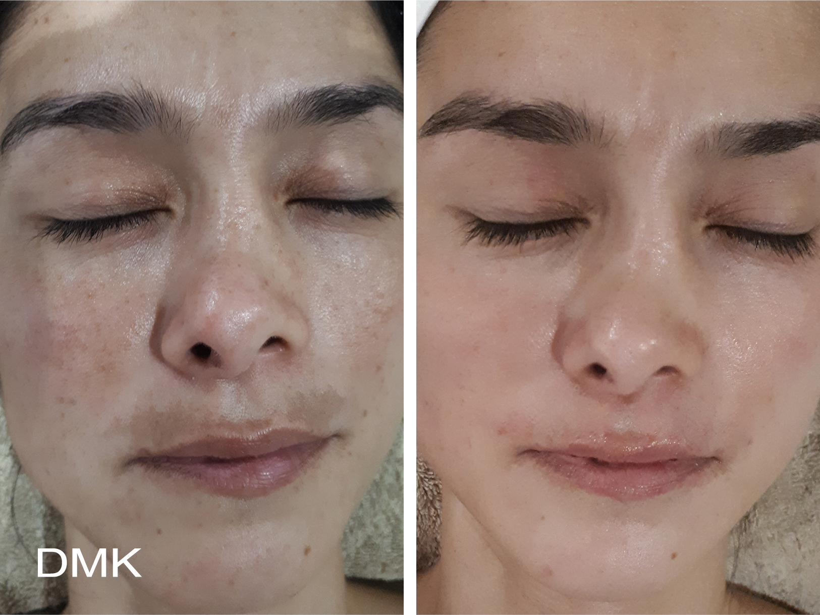 Pigmentation - DMK Results - DMKCustomer