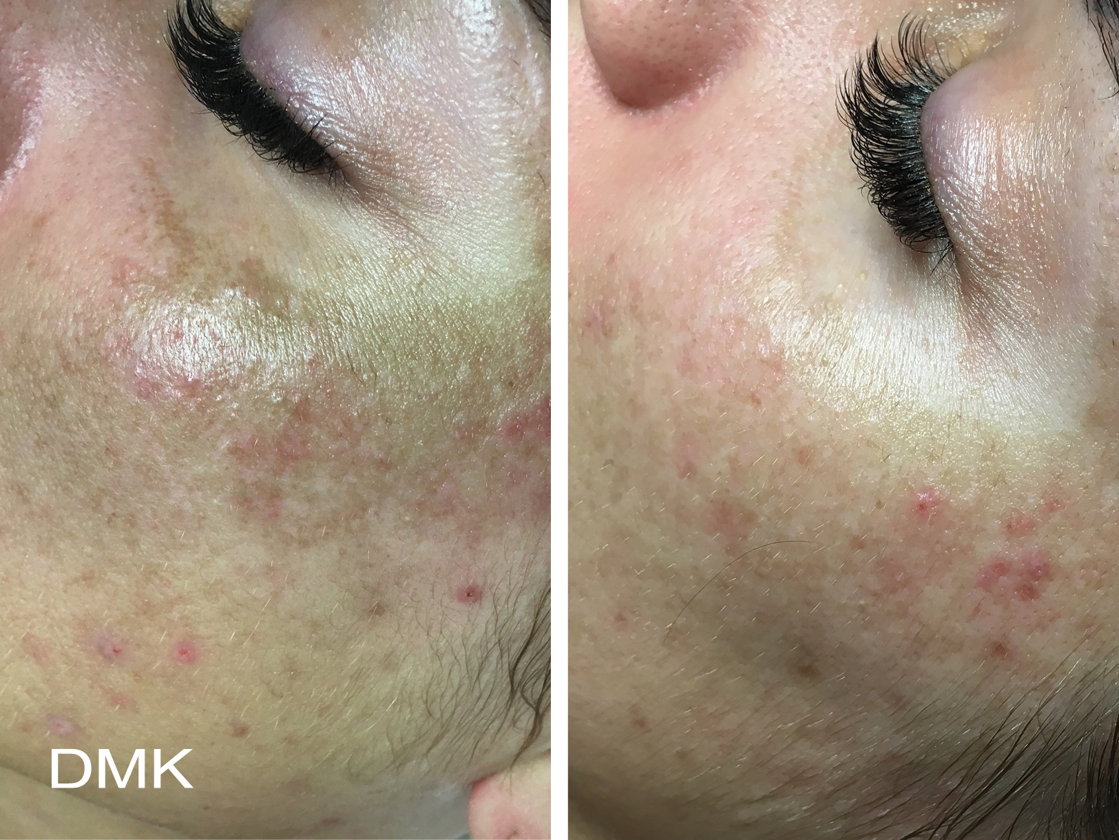 Pigmentation - DMK Results - DMKCustomer