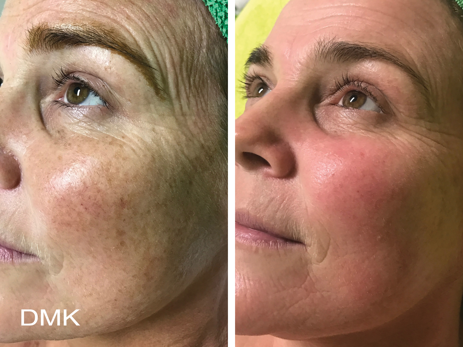 Pigmentation - DMK Results - DMKCustomer