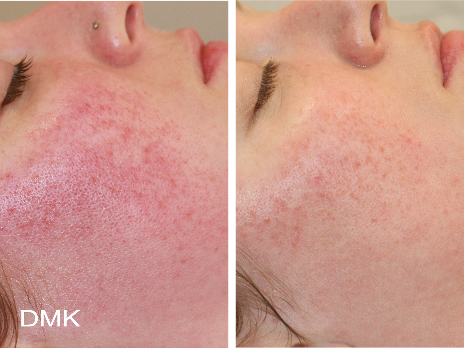 Reactive skin - DMK Results - DMKCustomer
