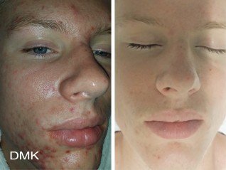 Acne - DMK Results - DMKCustomer